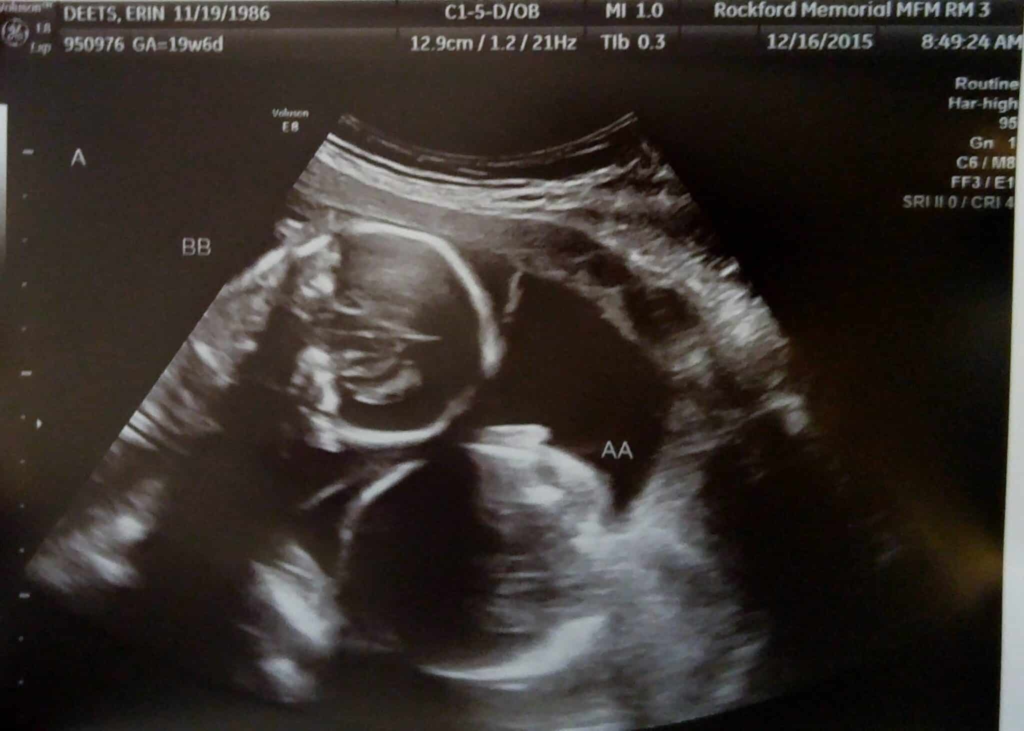 20 Weeks Pregnant With Twins Tips Advice And How To Prep Twiniversity