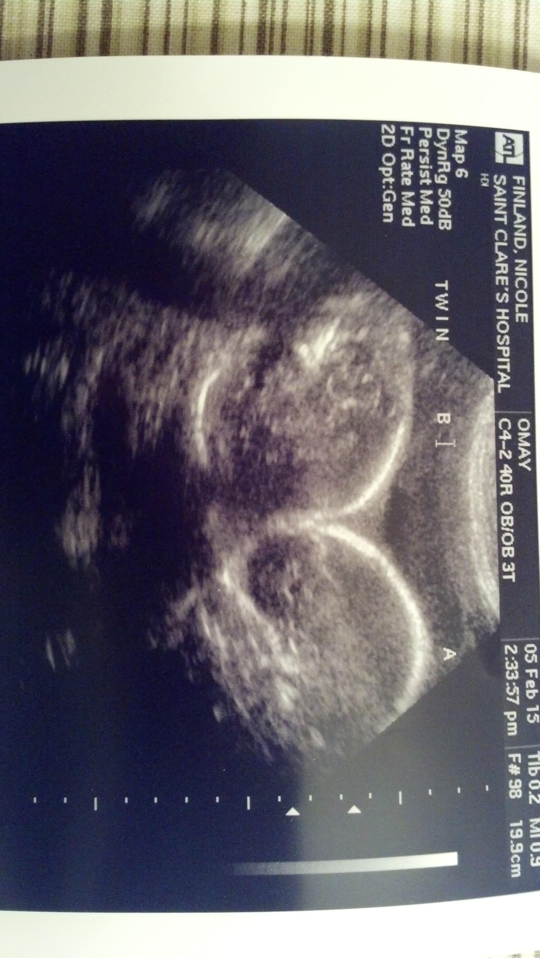 20 Weeks Pregnant With Twins Tips Advice And How To Prep Twiniversity